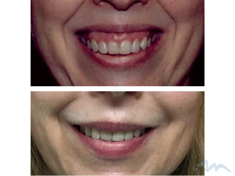 Dr. Wolf's BOTOX Patients - Miami Plastic Surgery