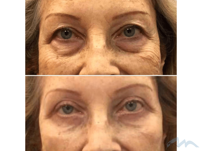 Dr. Wolf's Blepharoplasty Patients - Miami Plastic Surgery