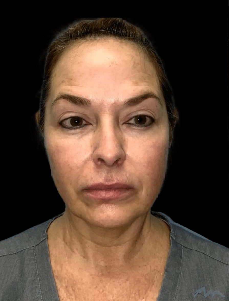 Gallery Cases Archive - Page 4 of 16 - Miami Plastic Surgery