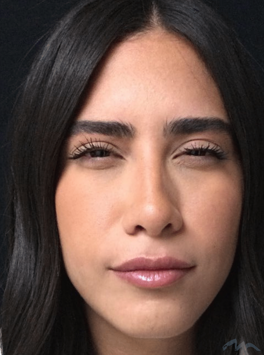 Facial Injectables Archives - Miami Plastic Surgery