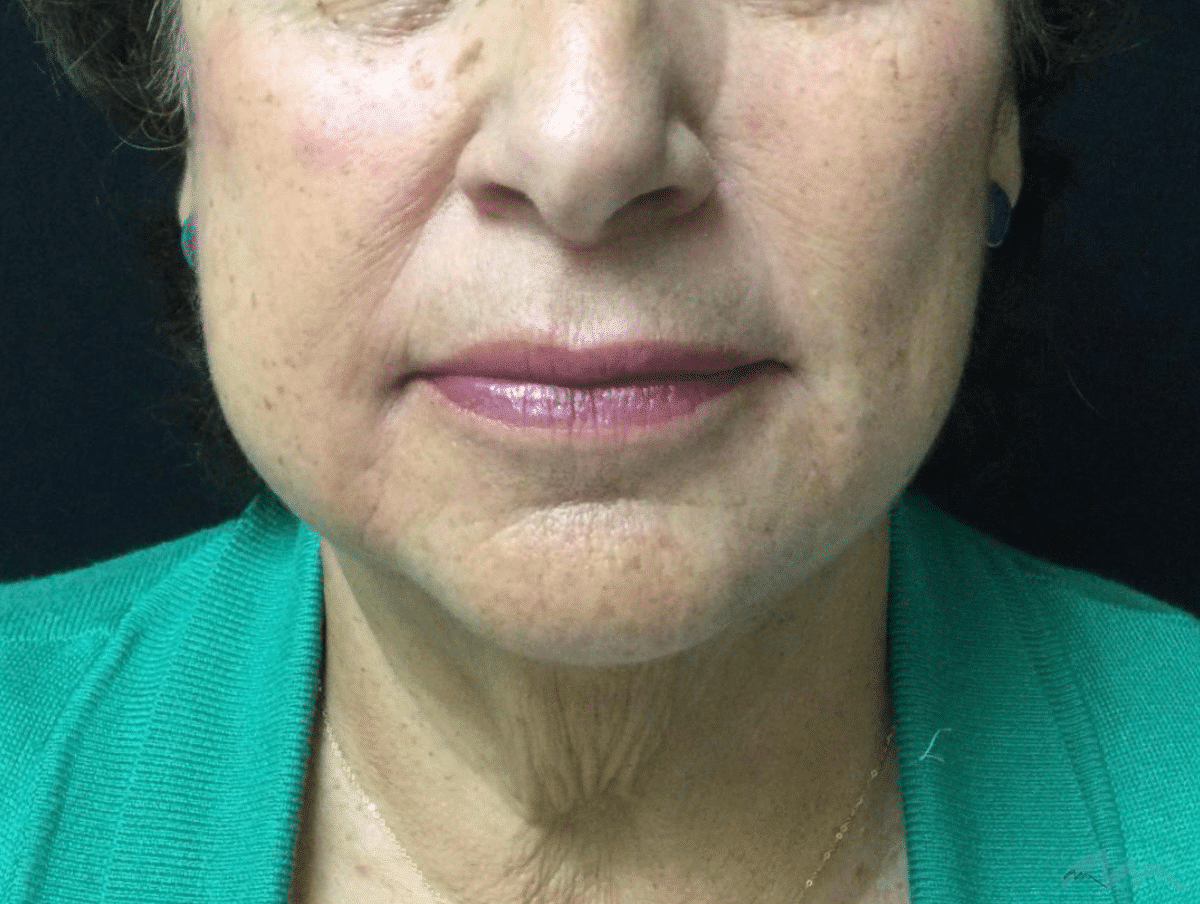 Facial Injectables Archives - Miami Plastic Surgery