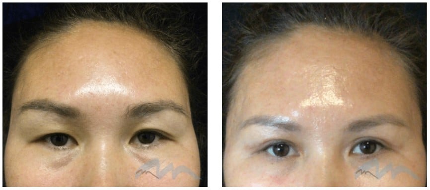 Dr. Max Polo's Blepharoplasty Patients - Miami Plastic Surgery
